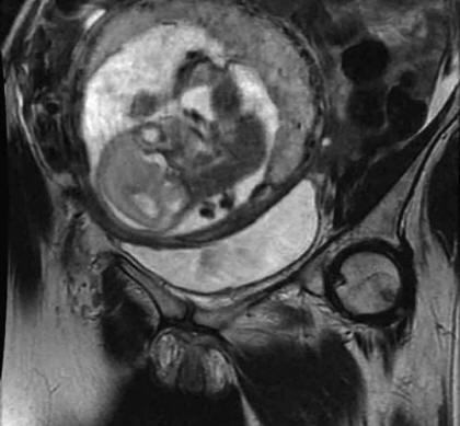 A Case of Muscle Invasive Bladder Cancer Treated With Systemic ...